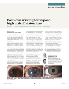 Article 'Cosmetic iris implants pose high risk of vision loss ...
